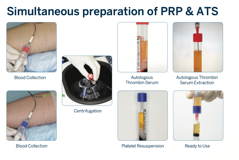 RegenATS - RegenLab | PRP Supplier | PRP kits