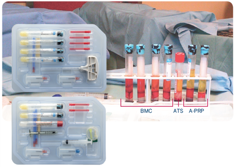 RegenKit Extracell BMC - RegenLab | PRP Supplier | PRP kits